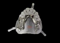 China Biocompatible Metal Framework Partial Dentures Featuring Strong Support Comfortable Design and Long Lasting Functionality for sale