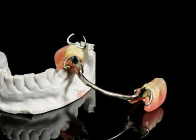 China Corrosion Resistant Metal Framework Partial Dentures providing long-term durability and function for dental laboratories for sale