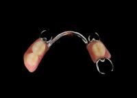 China Corrosion Resistant Metal Framework Partial Dentures providing long-term durability and function for dental laboratories for sale