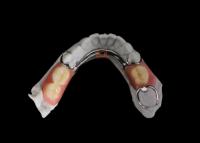 China Corrosion Resistant Metal Framework Partial Dentures providing long-term durability and function for dental laboratories for sale