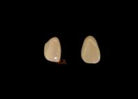 China Customizable Emax Dental Veneer designed to provide superior aesthetics and performance in dental prosthetics applications for sale