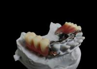 China Durable Metal Removable Partial Dentures Designed For Comfortable Fit Stability And Easy Maintenance In Partial Tooth Replacement Applications for sale