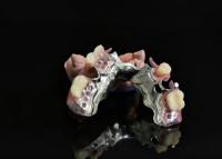 China Biocompatible Metal Framework Partial Dentures Crafted to Deliver Performance and Patient Satisfaction in Dental Practices for sale