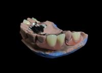 China Biocompatible Metal Framework Partial Dentures Crafted to Deliver Performance and Patient Satisfaction in Dental Practices for sale