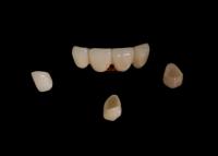 China Titanium Dental Implant Support Bar Durable Corrosion Resistant Precision Engineered for Secure Dental Prosthetics Applications for sale
