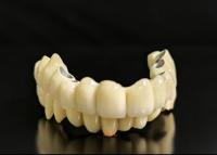 China Precision Engineered Porcelain Fused To Metal Crown Offering Strong Support And Natural Look For Dental Applications for sale