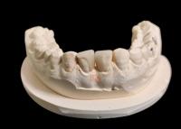 China High Strength Emax Veneer Dental Restoration Featuring Superior Resistance to Fracture and Wear for Dental Professionals for sale