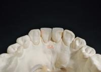 China High Strength Emax Veneer Dental Restoration Featuring Superior Resistance to Fracture and Wear for Dental Professionals for sale