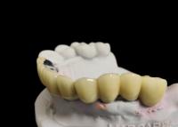 China Security Access Restricted Porcelain Fused To Metal Crown Dental Crowns Designed To Deliver And Natural Looking Restorations for sale
