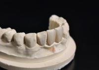 China High Strength Emax Ceramic Veneer with Natural Translucency and Color Stability Ensuring Long Term Patient Satisfaction for sale
