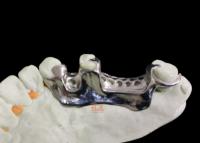 China Precision Engineered Durable Metal Framework Dentures delivering accurate fit and long-lasting stability for dental labs for sale