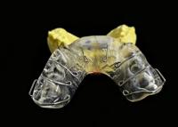 China Orthodontic Retainer with Transparent Acrylic Base and Stainless Steel Clasps for Post Orthodontic Teeth Stabilization for sale