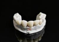 China Customizable Emax Dental Veneer Offering Superior Strength and Translucency Ideal for Professional Dental Applications for sale