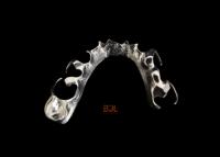 China Durable Comfortable Metal Framework Partial Dentures Designed for Long Lasting and Optimal Fit in Dental Applications for sale