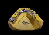 China Durable Comfortable Metal Framework Partial Dentures Designed for Long Lasting and Optimal Fit in Dental Applications for sale