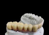China Displayed to user Porcelain Fused To Metal Crown customized dental crown ensuring optimal fit biocompatibility and natural tooth color matching for sale