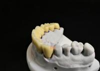 China Porcelain Fused To Metal Multi Crown Dental Bridge With Burr Free Inner Coping And Warm Yellow Porcelain Veneer For Long Term Stability for sale