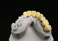 China Porcelain Fused To Metal Multi Crown Dental Bridge With Burr Free Inner Coping And Warm Yellow Porcelain Veneer For Long Term Stability for sale