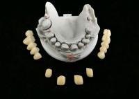 China Long Lasting Ceramic Dental Prosthesis Engineered to Meet the Demands of Dental Professionals and Laboratories Worldwide for sale