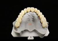 China Long Lasting Ceramic Dental Prosthesis Engineered to Meet the Demands of Dental Professionals and Laboratories Worldwide for sale