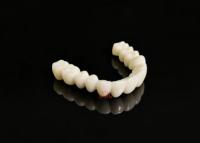 China Durable Porcelain Fused To Metal Crown Dental Restoration Solution Ideal For Long Lasting Strength And Natural Appearance for sale