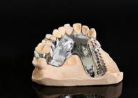 China Customizable Metal Framework Partial Dentures ensuring precise fit and enhanced patient comfort for dental professionals for sale