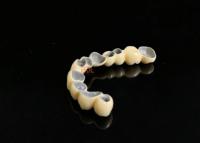 China Custom Porcelain Fused To Metal Dental Crowns Strong Metal Base With Aesthetic Porcelain Coating For Superior Durability for sale