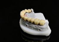 China Custom Porcelain Fused To Metal Dental Crowns Strong Metal Base With Aesthetic Porcelain Coating For Superior Durability for sale