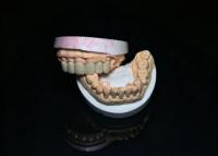 China Custom Porcelain Fused To Metal Crown Engineered To Deliver Optimal Strength And Aesthetic Appeal For Dental Prosthetics for sale