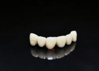 China Custom Porcelain Fused To Metal Crown Engineered To Deliver Optimal Strength And Aesthetic Appeal For Dental Prosthetics for sale