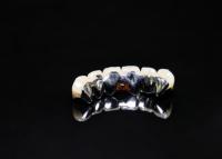 China Custom Porcelain Fused To Metal Crown Engineered To Deliver Optimal Strength And Aesthetic Appeal For Dental Prosthetics for sale