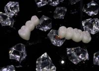 China Custom Fit Ceramic Dental Prosthesis Engineered to Deliver Durable and Natural Looking Solutions for Dental Laboratories for sale