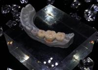 China Durable Porcelain Fused To Metal Crown Dental Restoration Solution Ideal For Long Lasting Strength And Natural Appearance for sale