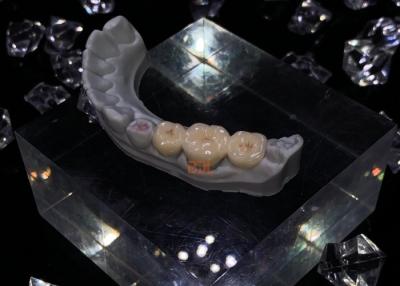 China Durable Porcelain Fused To Metal Crown Dental Restoration Solution Ideal For Long Lasting Strength And Natural Appearance for sale