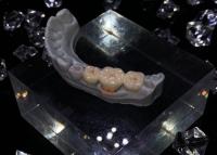 China Durable Porcelain Fused To Metal Crown Dental Restoration Solution Ideal For Long Lasting Strength And Natural Appearance for sale