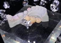 China Durable Porcelain Fused To Metal Crown Dental Restoration Solution Ideal For Long Lasting Strength And Natural Appearance for sale