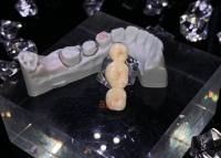 China Durable Porcelain Fused To Metal Crown Dental Restoration Solution Ideal For Long Lasting Strength And Natural Appearance for sale