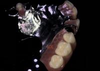 China Stainless Durable Metal Framework Partial Dentures designed to resist corrosion and provide dental restoration solutions for sale