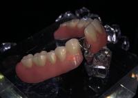 China Openresty Server Software Based Metal Framework Partial Dentures Featuring Customizable Fit and Long Lasting Performance for sale