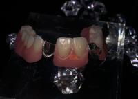 China Openresty Server Software Based Metal Framework Partial Dentures Featuring Customizable Fit and Long Lasting Performance for sale
