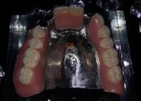 China Openresty Server Software Based Metal Framework Partial Dentures Featuring Customizable Fit and Long Lasting Performance for sale