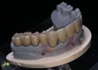 China Custom fit Ceramic Dental Prosthetics featuring excellent strength natural look and performance in restorative dental applications for sale