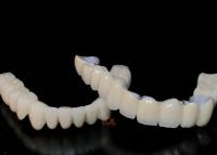 China Custom Designed Porcelain Fused To Metal Crown Combining Strength And Esthetics For Long Term Dental Restoration Success for sale