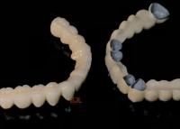 China Custom Designed Porcelain Fused To Metal Crown Combining Strength And Esthetics For Long Term Dental Restoration Success for sale