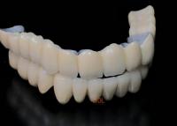China Custom Designed Porcelain Fused To Metal Crown Combining Strength And Esthetics For Long Term Dental Restoration Success for sale