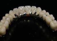 China Custom Fit Dental Implant Support Bar Made from Titanium Alloy Providing Support and Long Term Durability in Implant Dentistry for sale