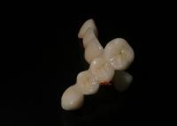 China Durable Ceramic Dental Prosthesis Custom Made Precision Engineered Solutions for Dental Laboratories and Clinics for sale