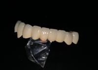 China Long Lasting Porcelain Fused To Metal Crown Durable Material Custom Shade Matching Precision Fit Dental Crown for sale