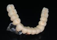 China Custom Porcelain Fused To Metal Crown Designed To Provide Long Term Stability And Natural Look Ideal For Professional Dental for sale