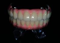 China Titanium Custom Dental Implant Bar Engineered to Provide Superior Support and Stability for Dental Prosthetic Devices for sale